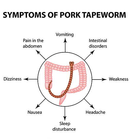 Cysticercosis | Symptoms Of A Tapeworm Infection | IIL